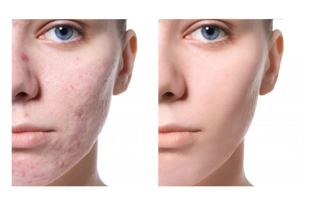 Cicatrici da acne | Chirurgia Plastica e Medicina Estetica | Il Tuo ...